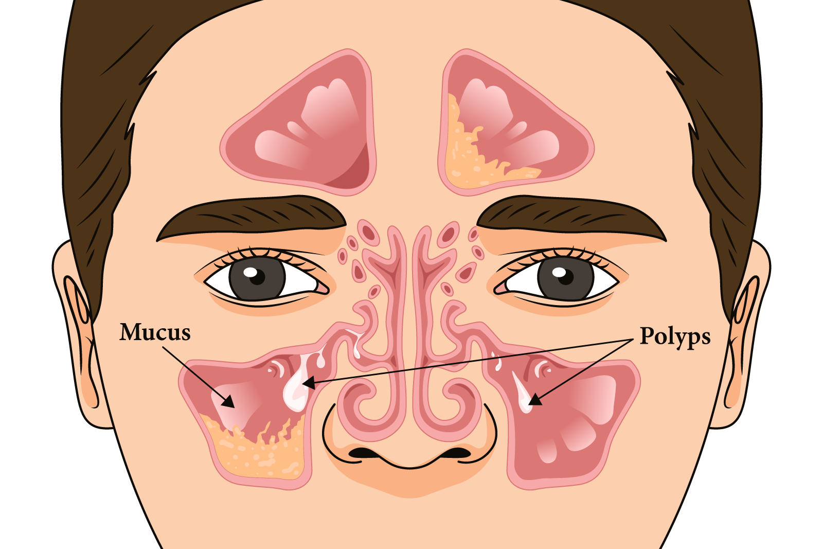 When Is A Biologic Indicated For Chronic Rhinosinusitis With Nasal